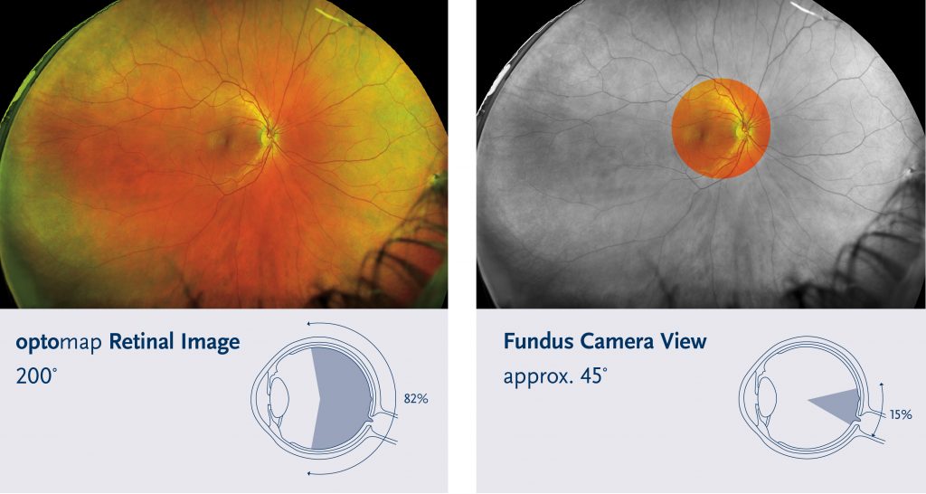 Optomap: The world’s most advanced scan of your retina - Finchley's ...