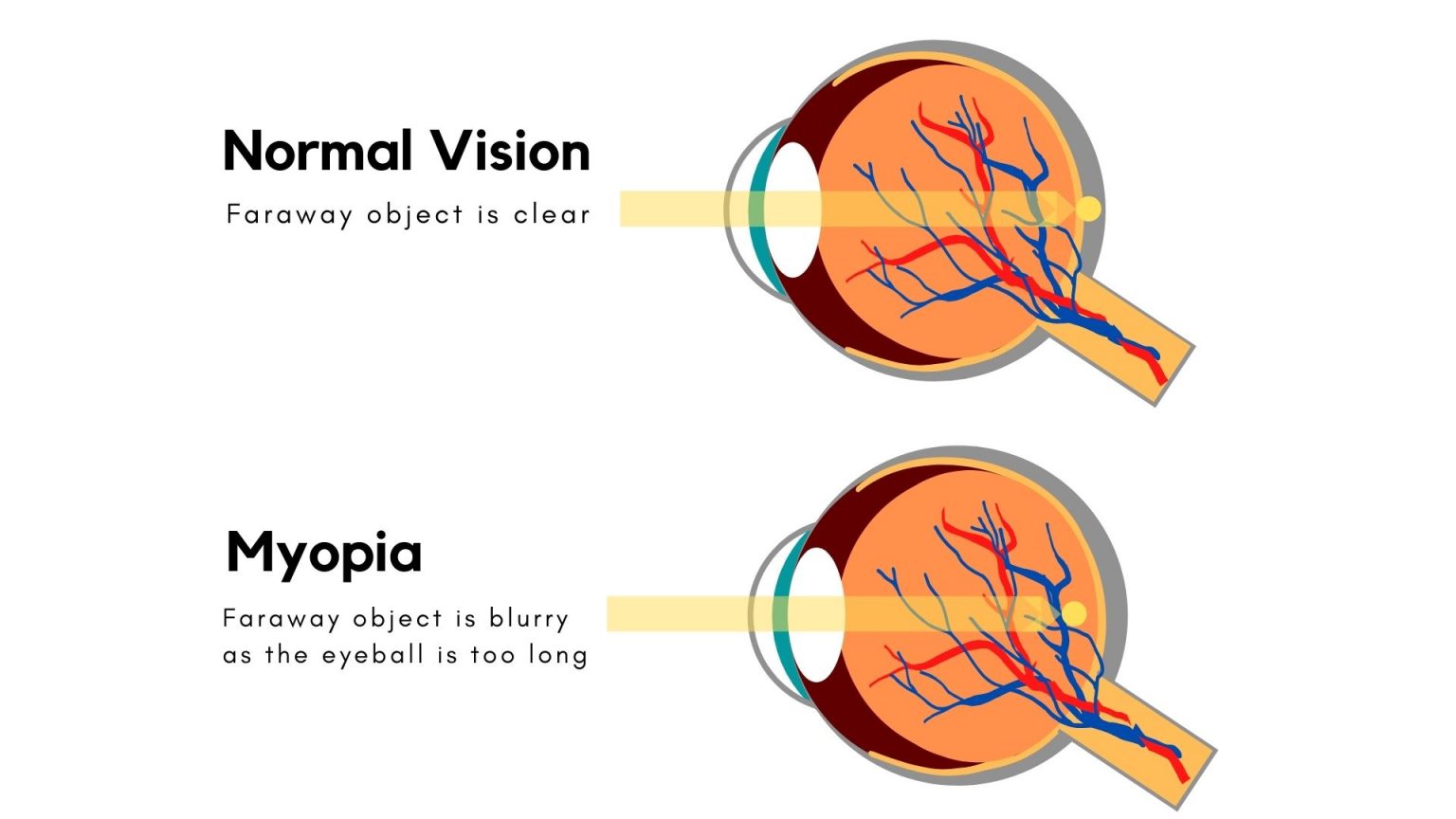 MiSight Contact Lenses | How To Keep Myopia Under Control - Finchley's ...